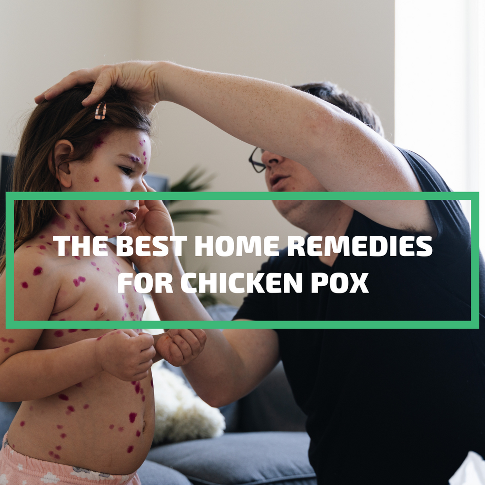 20 of The Best Home Remedies for Chicken Pox (2025) – RiiRoo